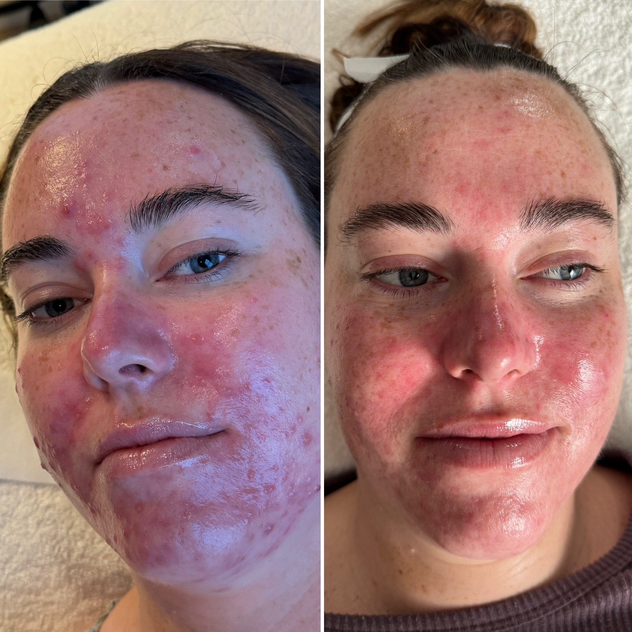 Acne Clearing Facial - Aesthetics By Bri - Treat Your Skin